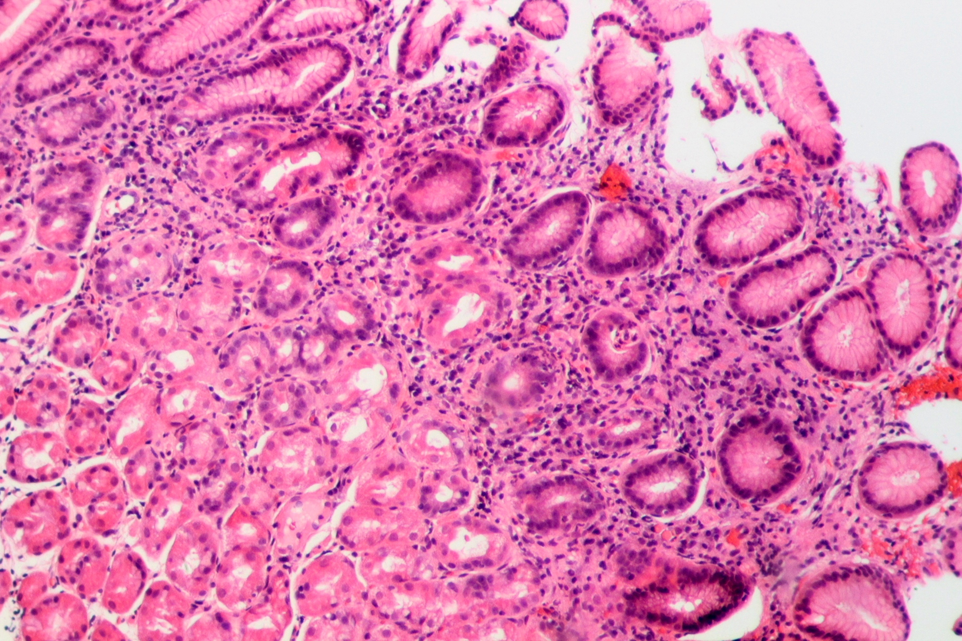 Helicobacter pylori, principal causa de la gastritis crónica y cáncer ...
